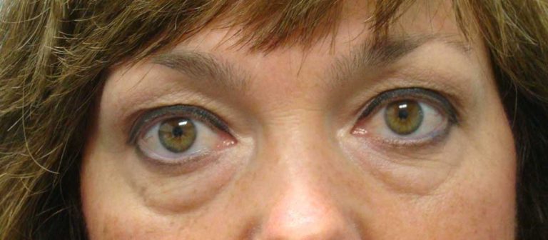 SOOF Lift Before & After Photos – Eyelid Surgery | Gossman, MD