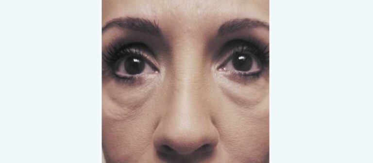 SOOF Lift Before & After Photos – Eyelid Surgery | Gossman, MD