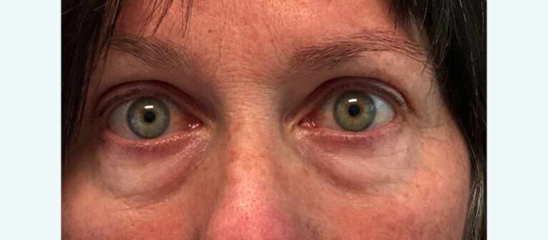 SOOF Lift Before & After Photos – Eyelid Surgery | Gossman, MD